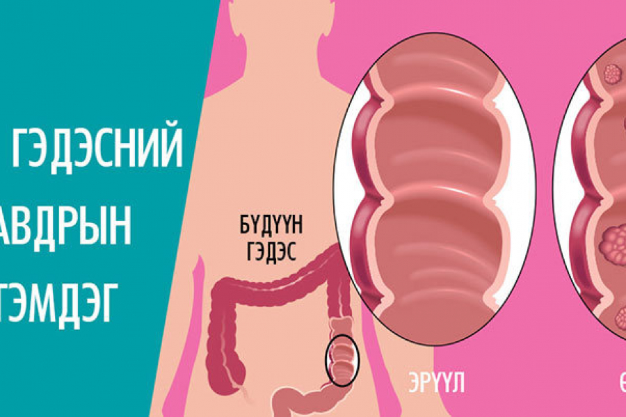 Бүдүүн гэдэсний хавдар АНУ Монголд